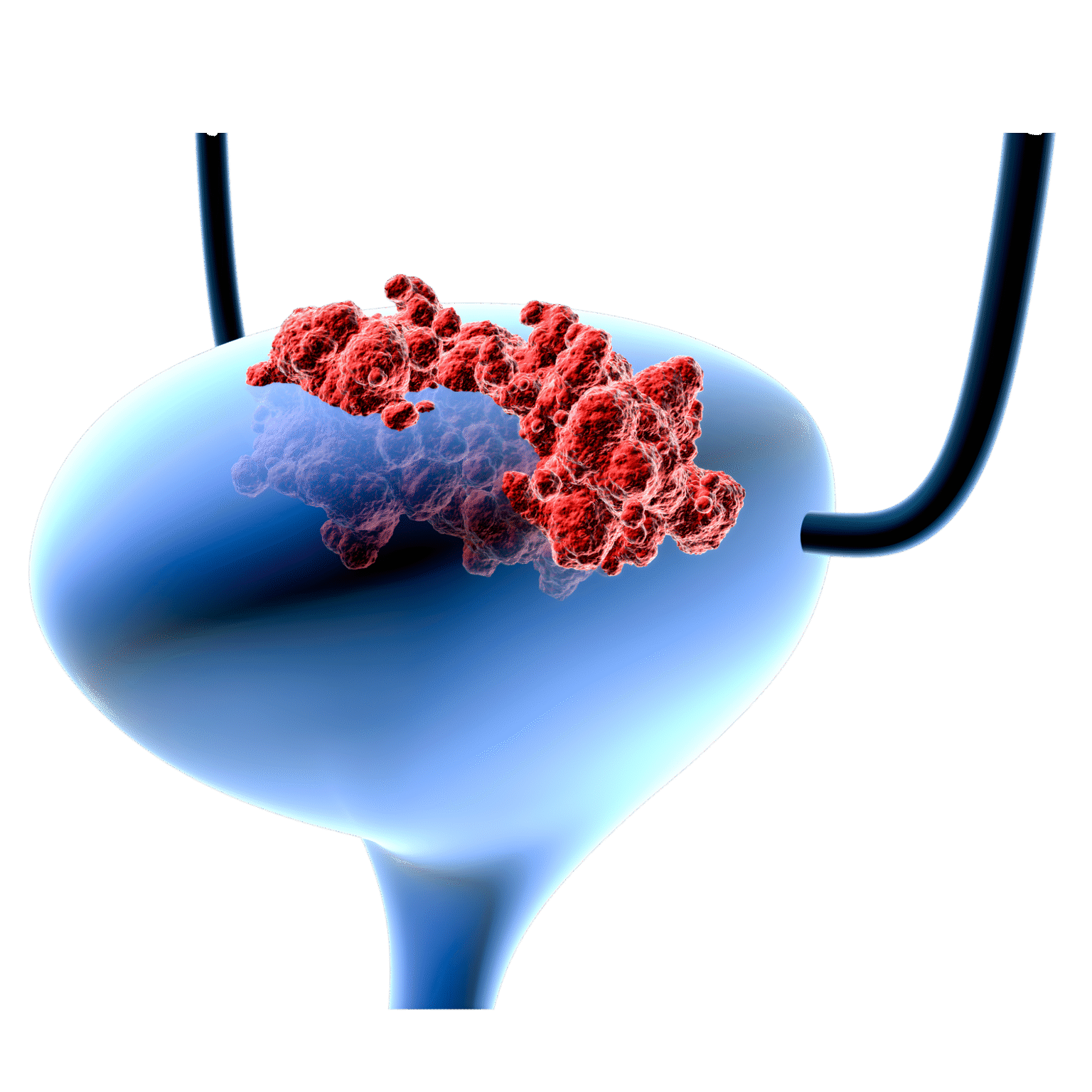 Case Study: Successful Treatment of Bladder Cancer and Reconstruction ...