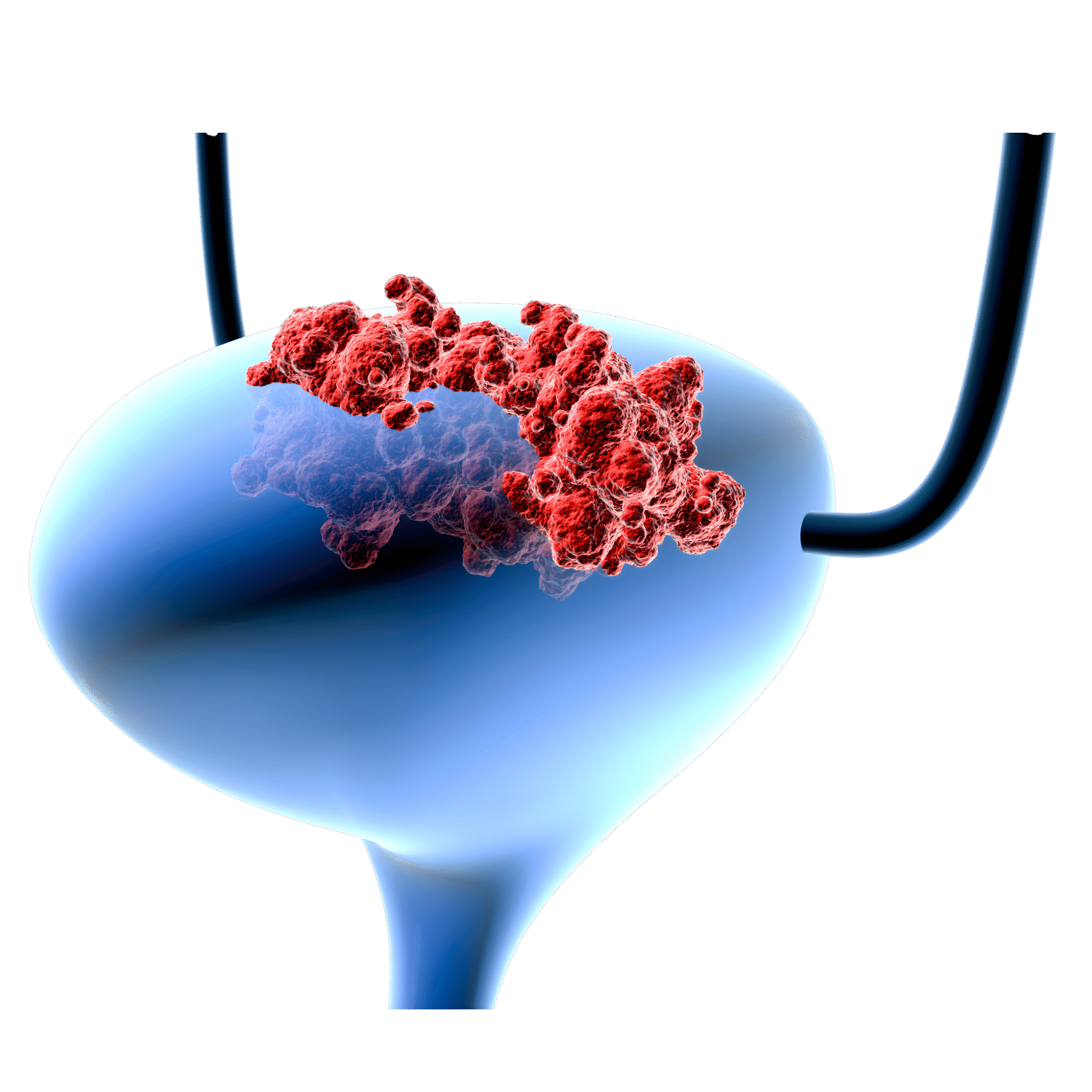 Case Study: Successful Treatment of Bladder Cancer and Reconstruction ...